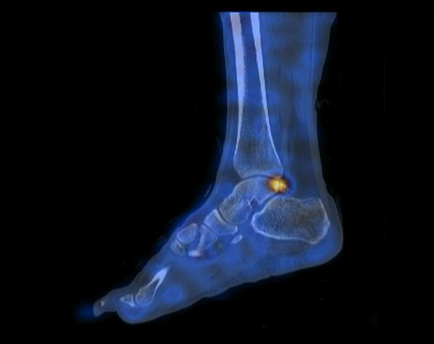 BENEFITS OF NUCLEAR IMAGING FOR FOOT & ANKLE PAIN - Mayfair Diagnostics
