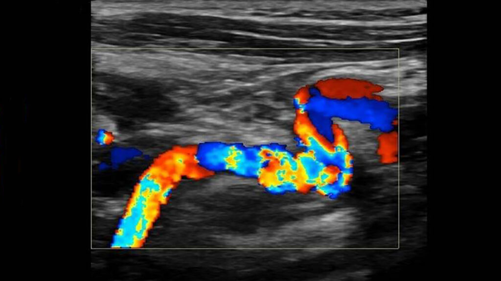 WHAT IS VASCULAR ULTRASOUND? - Mayfair Diagnostics