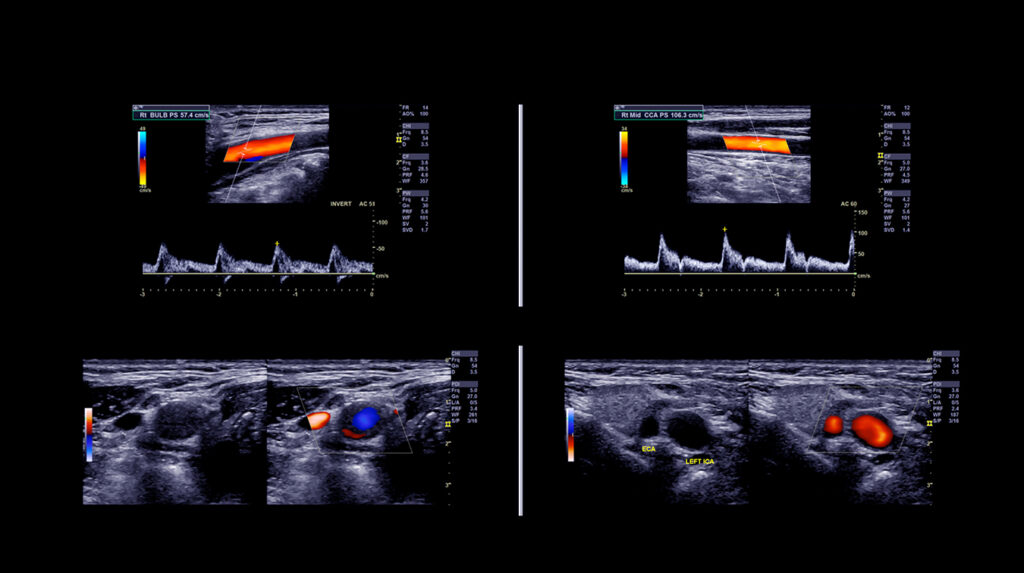 WHAT IS VASCULAR ULTRASOUND? - Mayfair Diagnostics