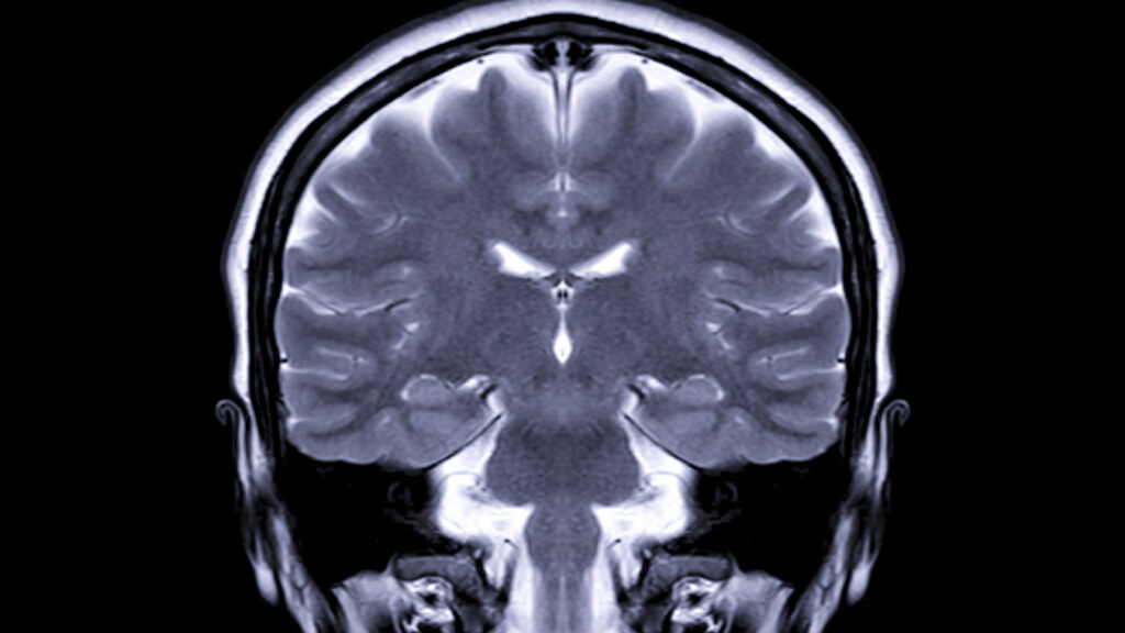 BRAIN TUMOURS AND MRI - Mayfair Diagnostics