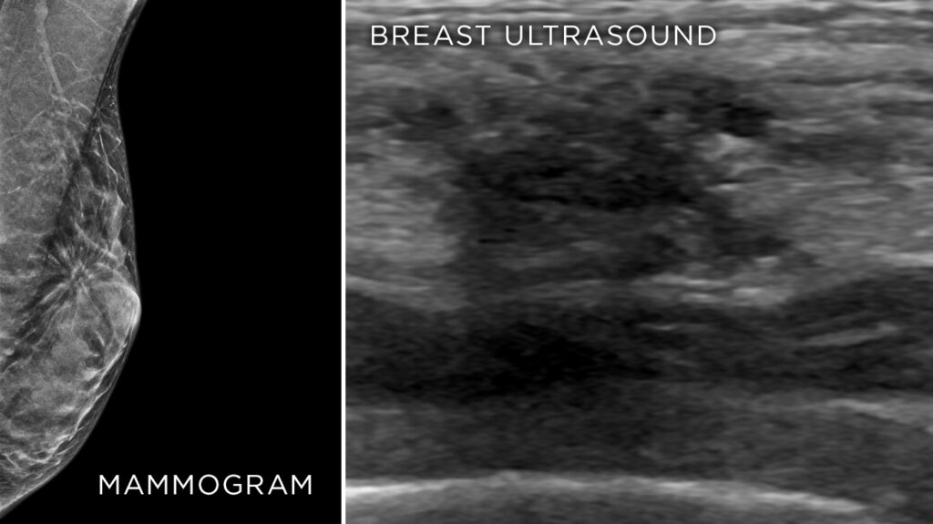 WHAT’S THE DIFFERENCE BETWEEN MAMMOGRAPHY AND BREAST ULTRASOUND ...
